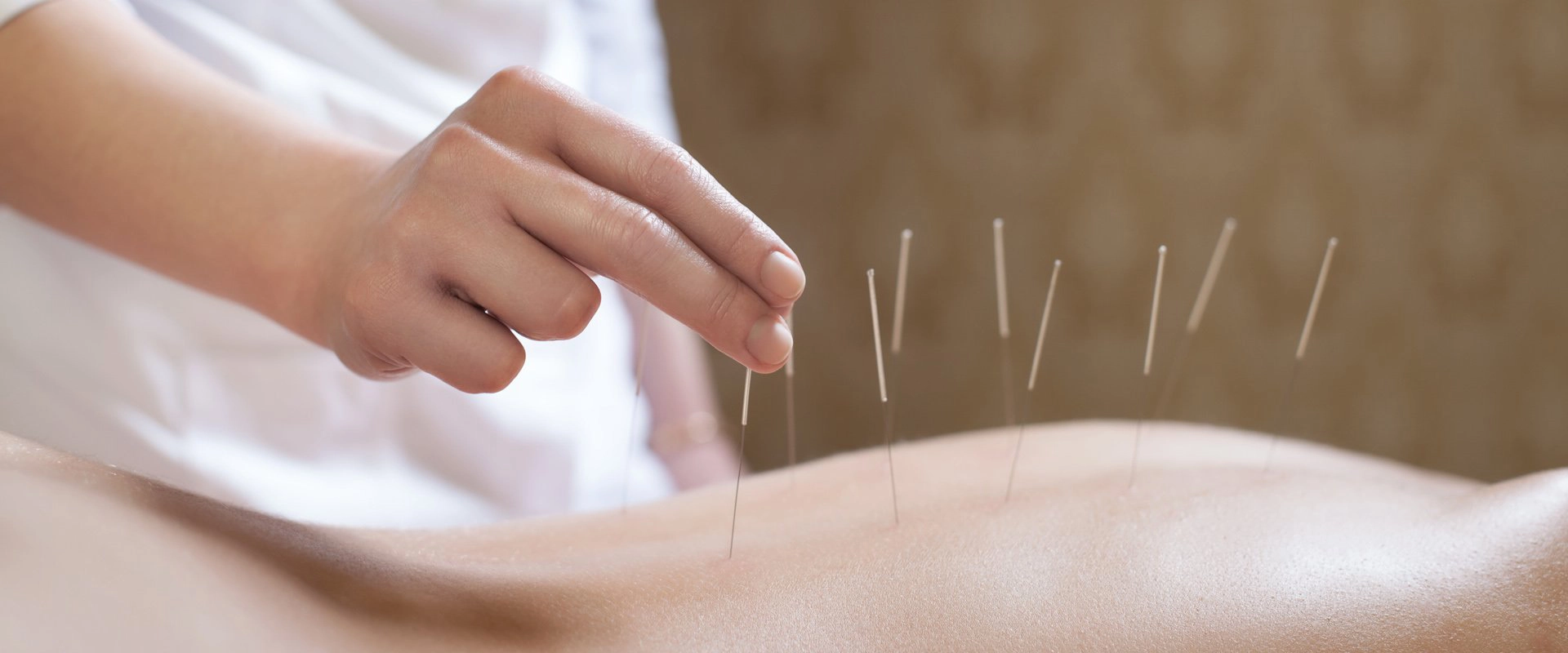 Acupuncture for Stress & Anxiety: Natural Relief for Mental Health